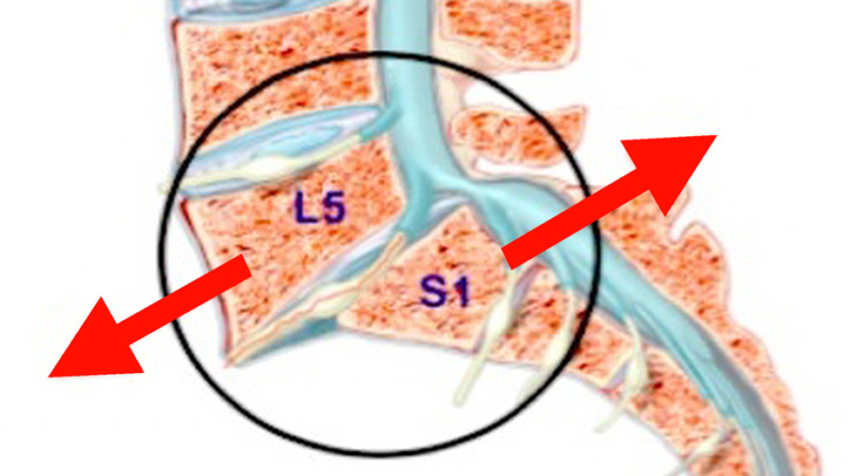 Spondilolisi e Spondilolistesi – Fisio P